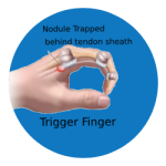 Trigger Finger - Dr Naveen Reddy