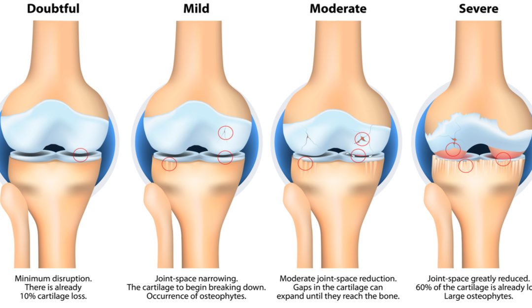 Osteoarthritis Knee Treatment Options Dr Naveen Reddy